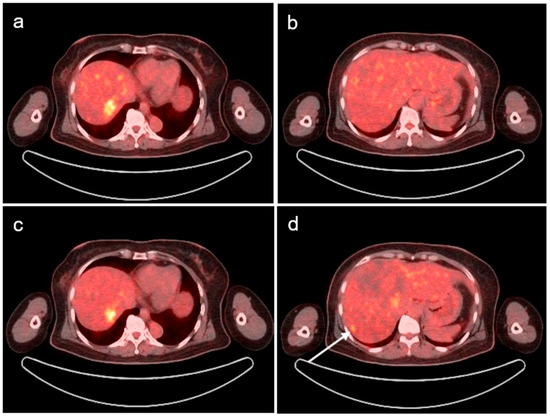 Detection of Hepatic Metastasis from Early Delayed Images of Modified ...