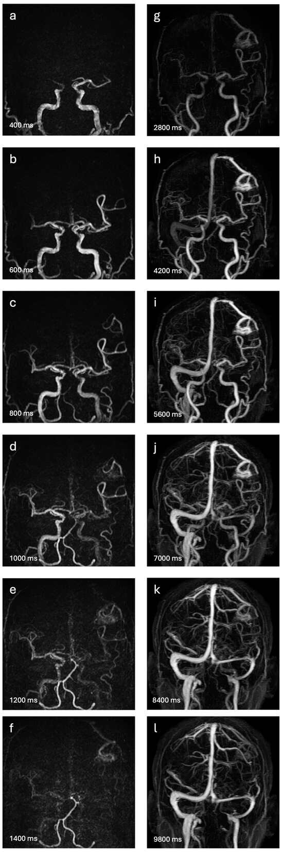 Diagnostic Accuracy of Non-Contrast-Enhanced Time-Resolved MR ...