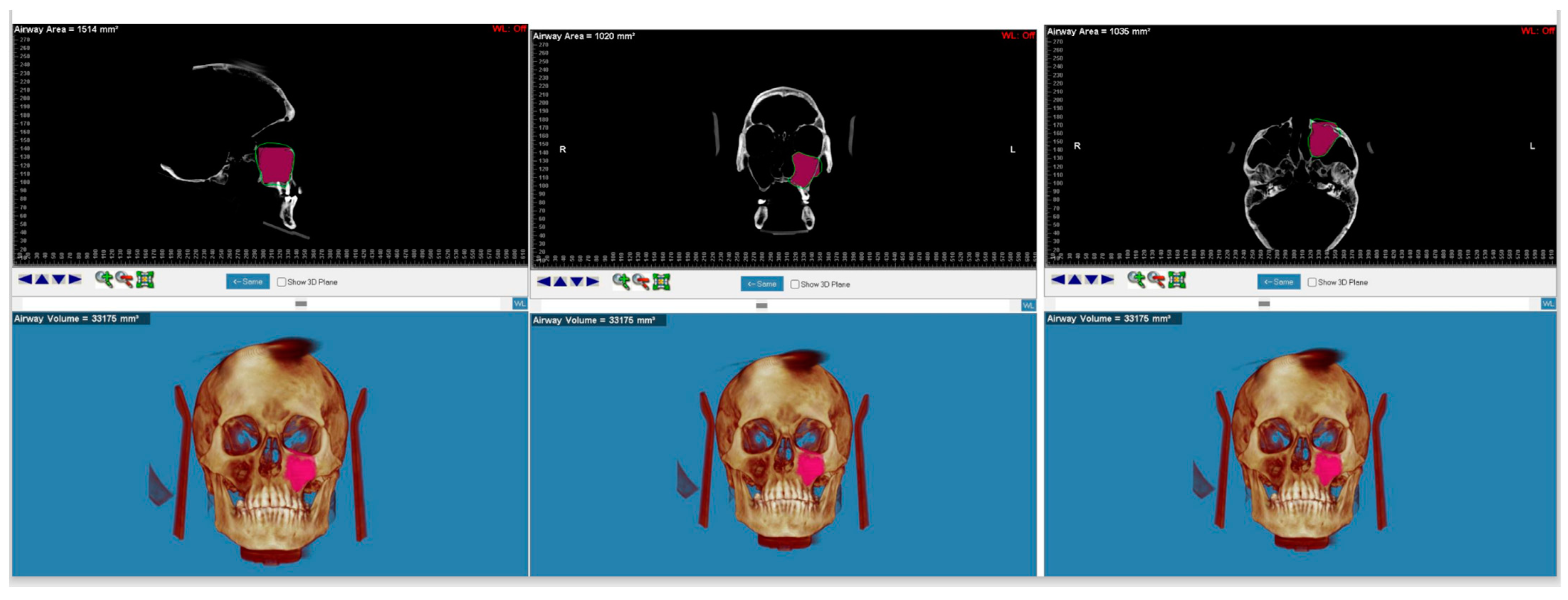 Three-Dimensional Analysis of the Maxillary Sinuses in Ancient Crania ...