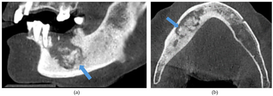 The Role of Cone Beam Computed Tomography (CBCT) in the Diagnosis and ...