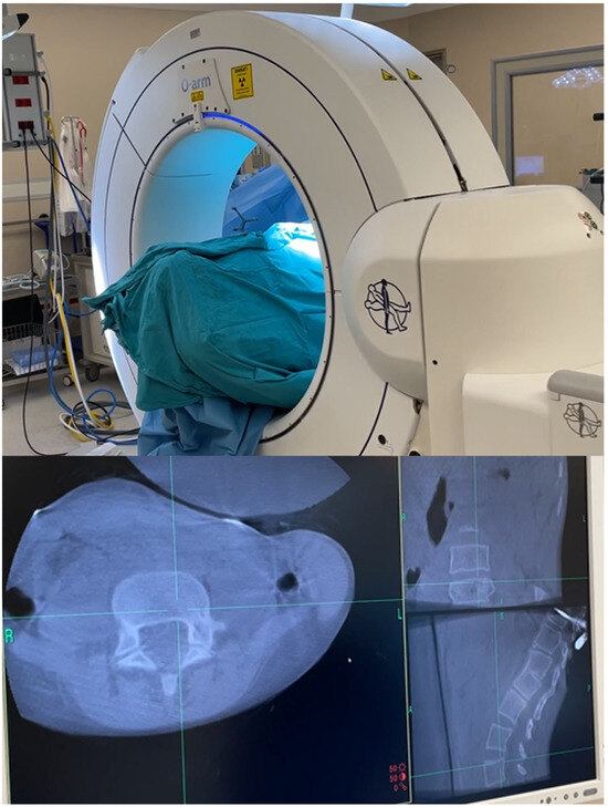 Unlocking Precision in Spinal Surgery: Evaluating the Impact of ...