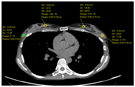 Breast Collagen Organization: Variance by Patient Age and Breast Quadrant