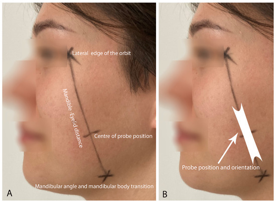 Assessment of Reliability, Agreement, and Accuracy of Masseter Muscle ...