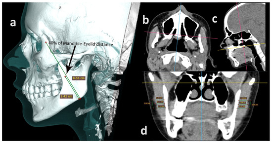 Assessment of Reliability, Agreement, and Accuracy of Masseter Muscle ...