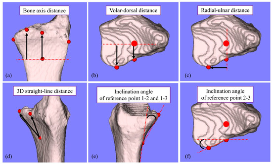 Three-Dimensional Morphometric Analysis of the Volar Cortical Shape of ...