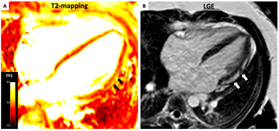 Clinical Applications of Cardiac Magnetic Resonance Parametric Mapping