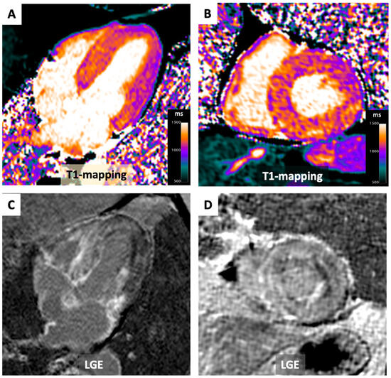 Clinical Applications of Cardiac Magnetic Resonance Parametric Mapping