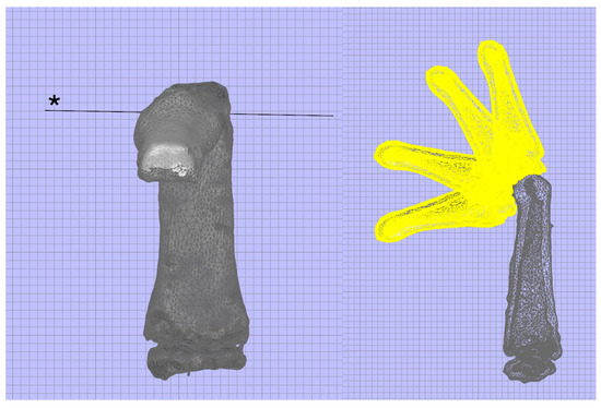 Quantitative Measurement of Rotation in Phalangeal Fracture Malunion ...