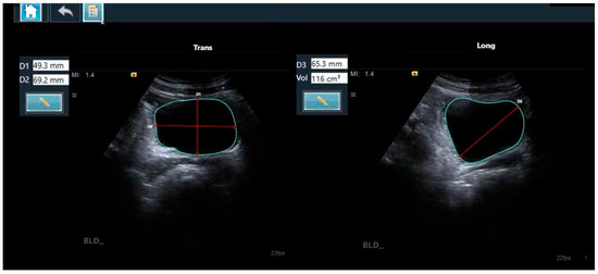 Revolutionizing Bladder Health: Artificial-Intelligence-Powered Automatic Measurement of Bladder ...