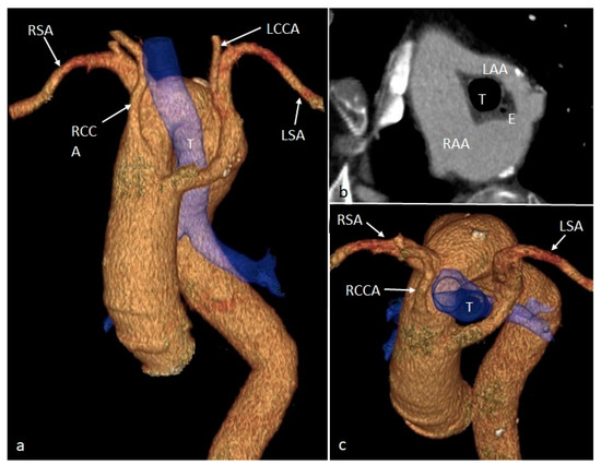 CT Angiography for Aortic Arch Anomalies: Prevalence, Diagnostic ...