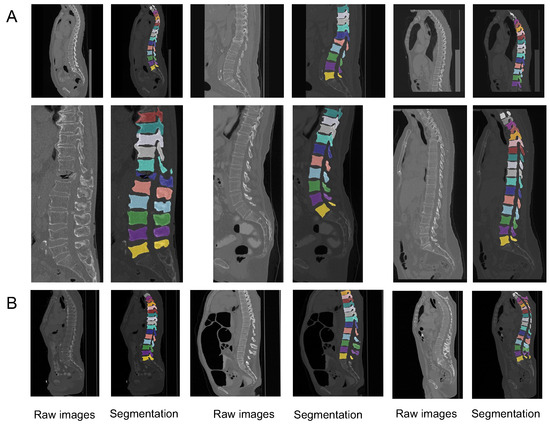 VerFormer: Vertebrae-Aware Transformer for Automatic Spine Segmentation from CT Images
