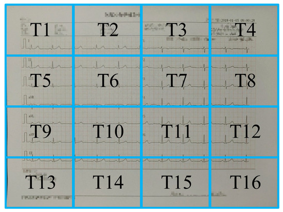 Paper-Recorded ECG Digitization Method with Automatic Reference Voltage ...