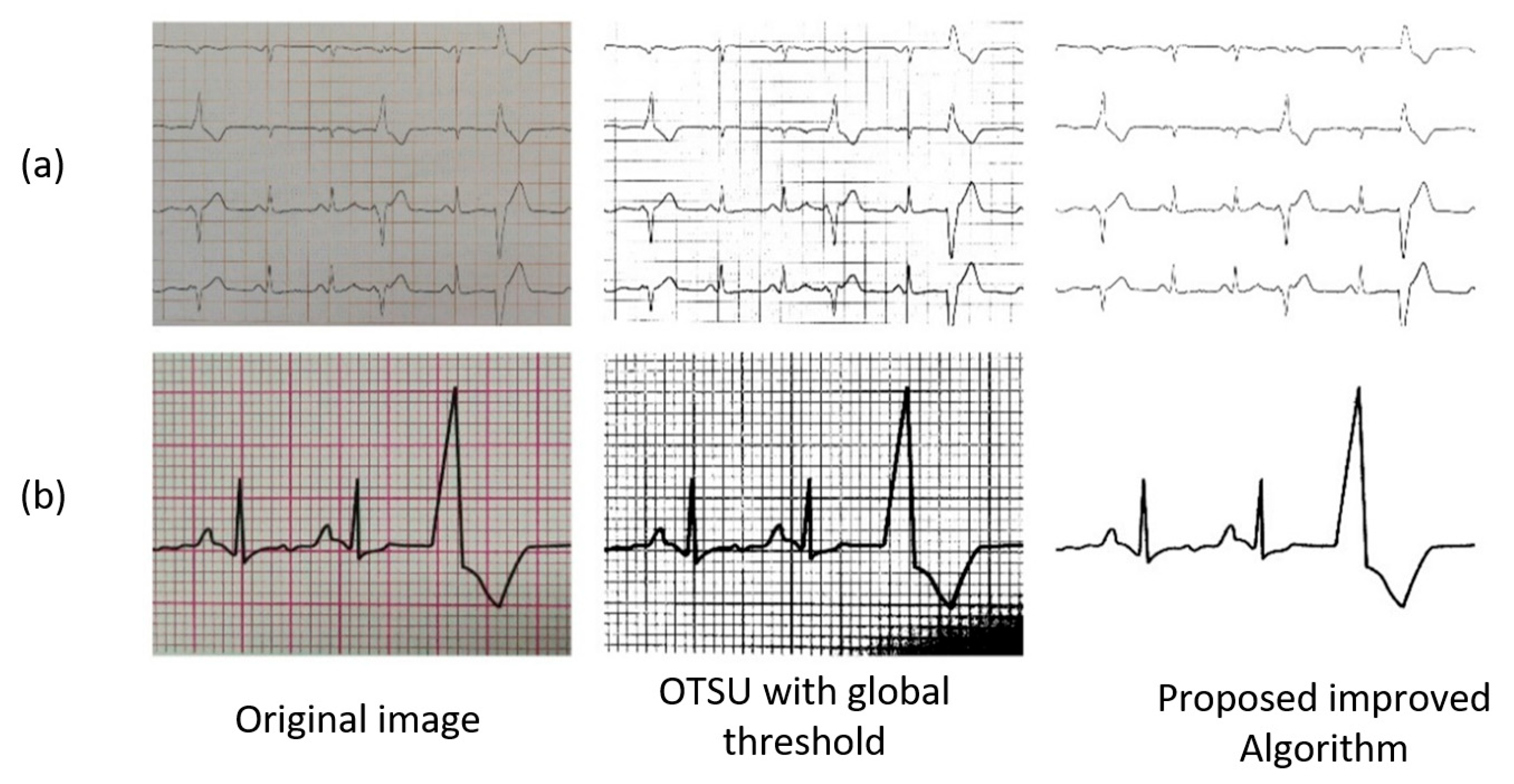 Paper-Recorded ECG Digitization Method with Automatic Reference Voltage ...