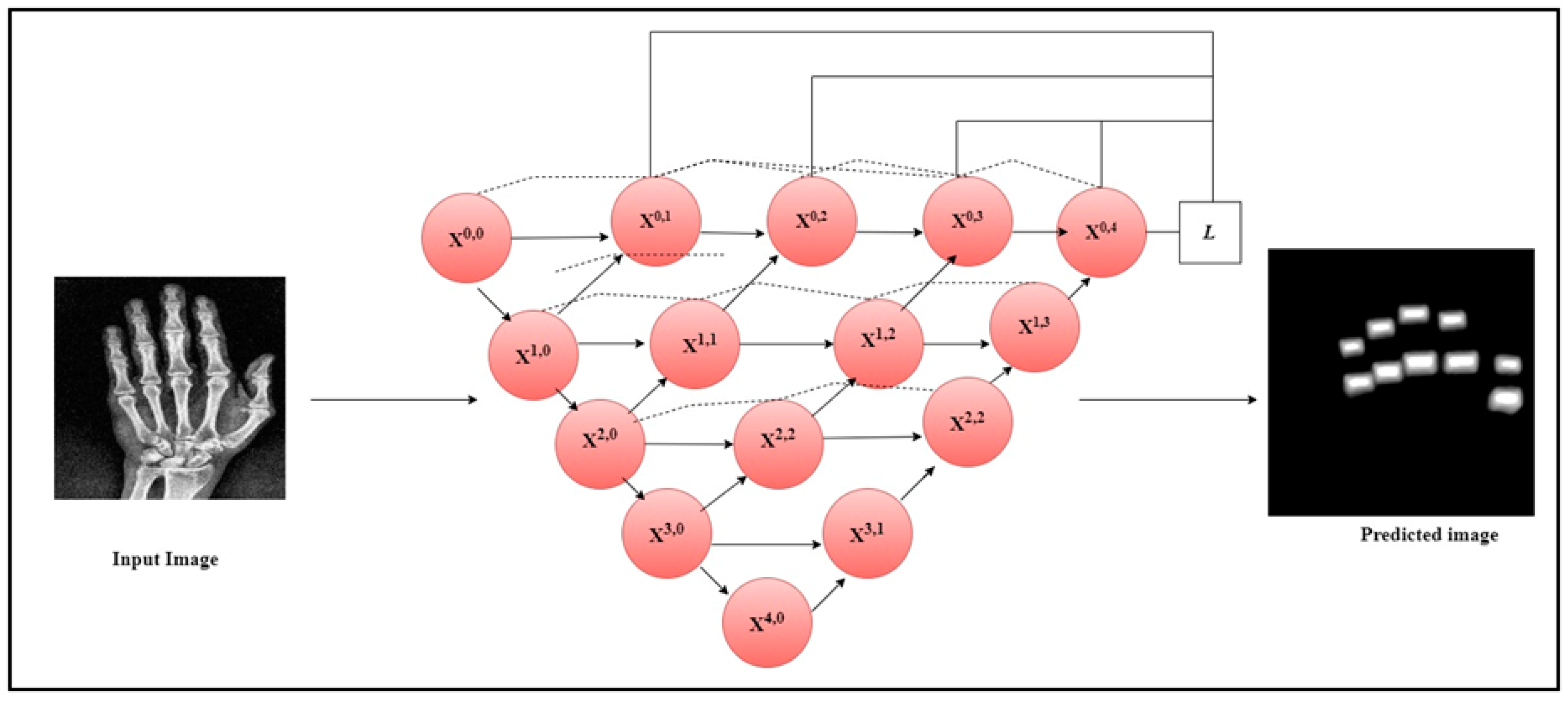 RA-XTNet: A Novel CNN Model to Predict Rheumatoid Arthritis from Hand ...