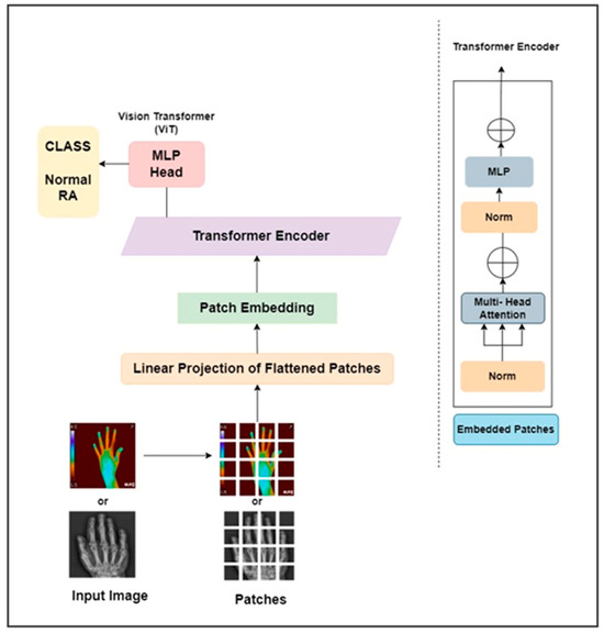 RA-XTNet: A Novel CNN Model to Predict Rheumatoid Arthritis from Hand ...
