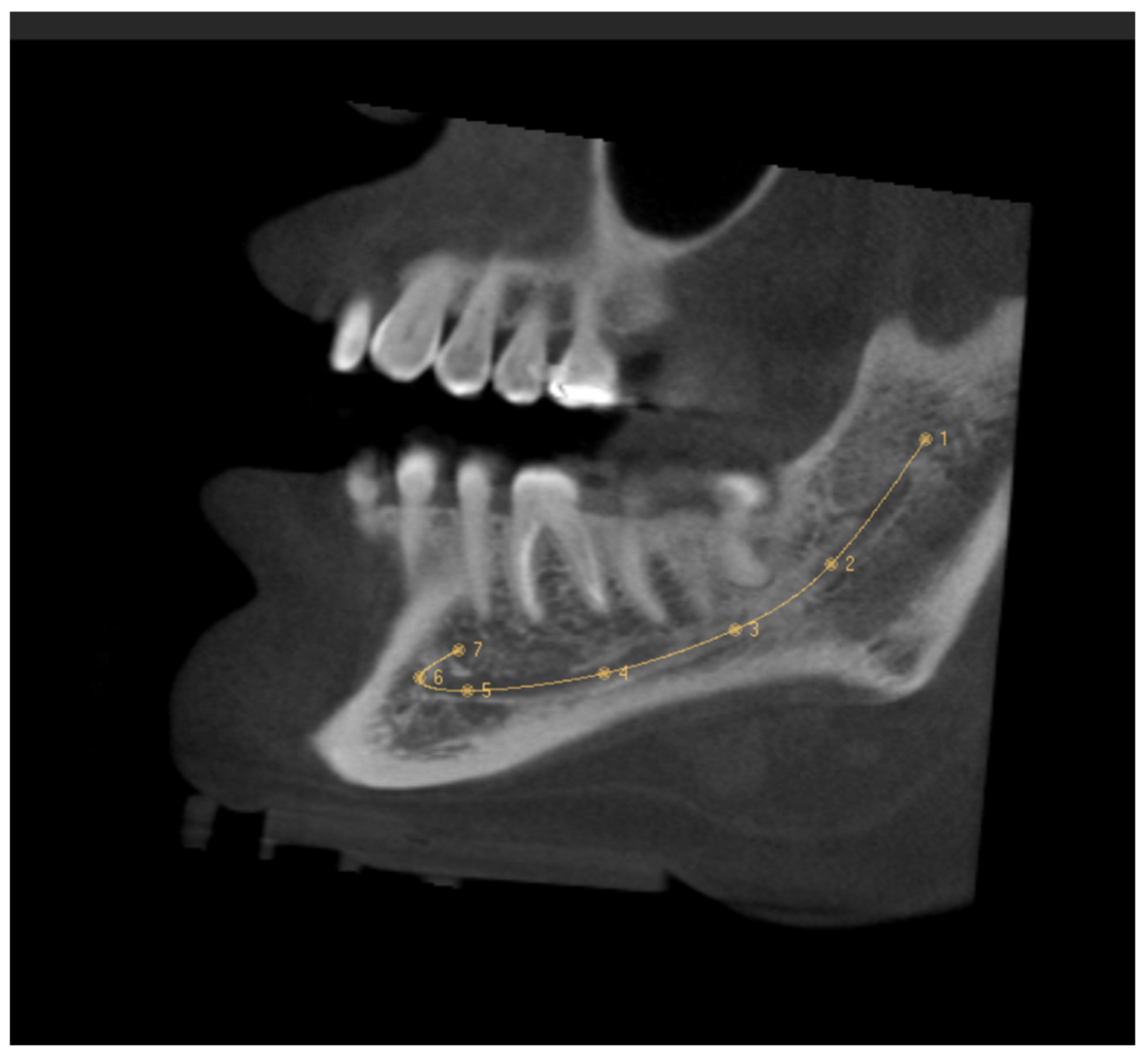 Mandibular Canal Radiograph