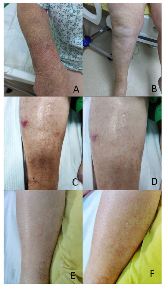 Capillary Leak Syndrome Associated with Anaplastic T Cell Lymphoma and Transcutaneous Exudation ...