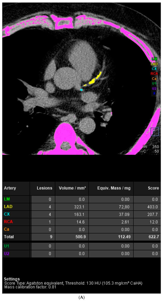 Discrepancies between Coronary Artery Calcium Score and Coronary Artery ...