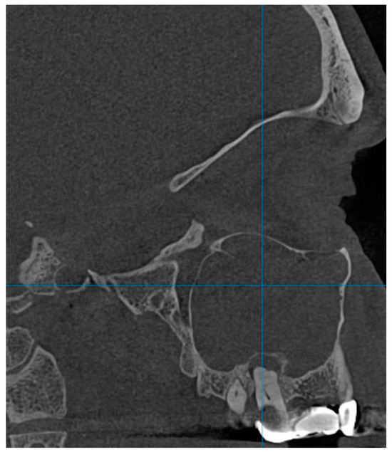 Preoperative Cone Beam Computed Topography Assessment of Maxillary ...