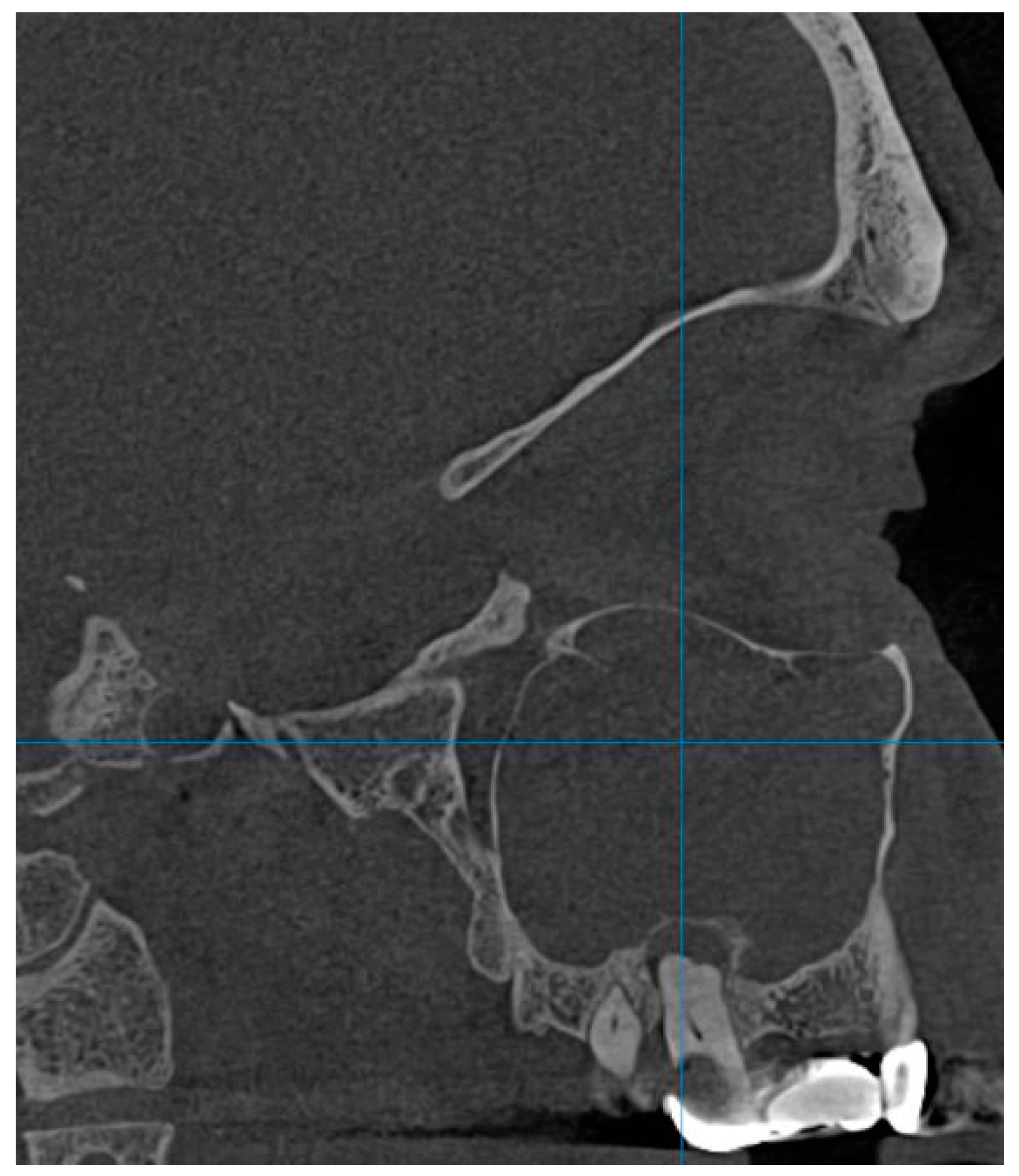 Preoperative Cone Beam Computed Topography Assessment of Maxillary ...
