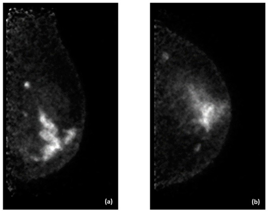 Radiotracer Innovations in Breast Cancer Imaging: A Review of Recent ...