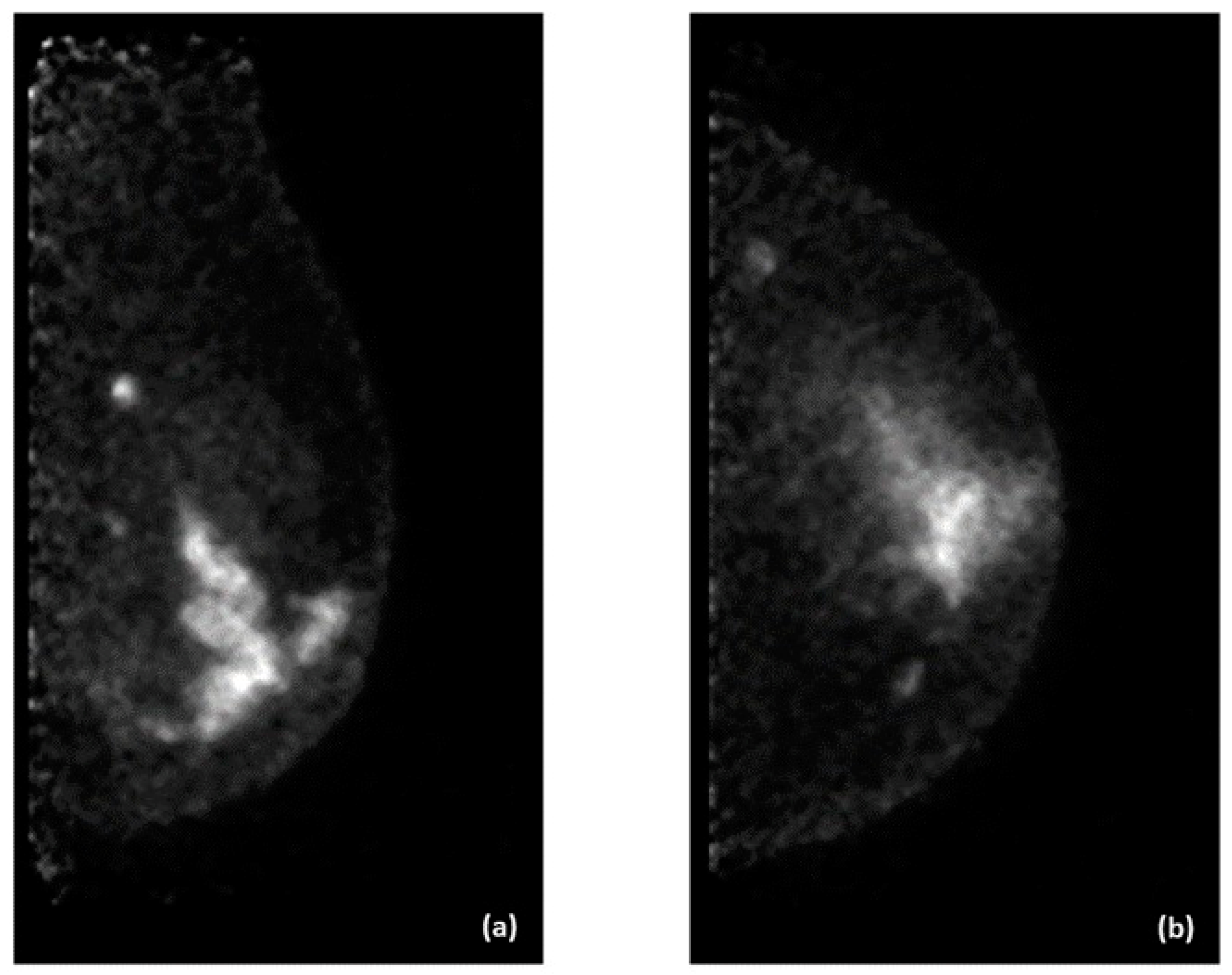 Radiotracer Innovations in Breast Cancer Imaging: A Review of Recent ...