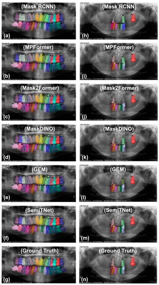 A Semi-Supervised Transformer-Based Deep Learning Framework for Automated Tooth Segmentation and ...