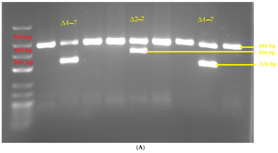 Ikaros Deletions among Bulgarian Patients with Acute Lymphoblastic ...