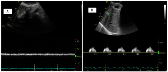 Portal Vein Pulsatility: A Valuable Approach for Monitoring Venous ...