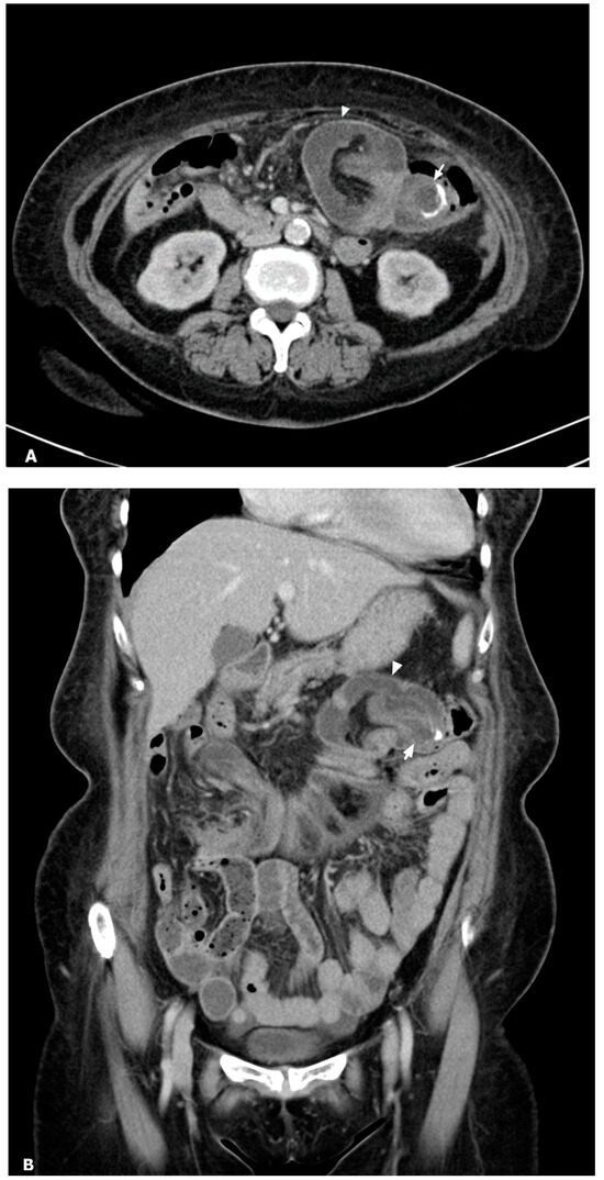 Ileocolic Intussusception Due to Low-Grade Appendiceal Mucinous Neoplasm