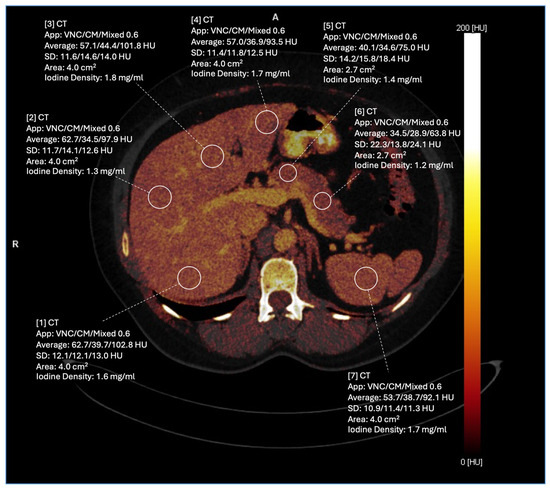 Standardization of Dual-Energy CT Iodine Uptake of the Abdomen and ...