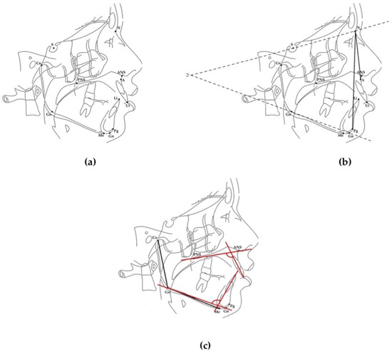 Evaluation of Incisor Position in a Sample of Orthodontic Patients
