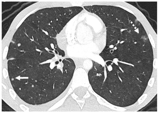 Osteosarcoma Metastasis to the Thorax: A Pictorial Review of Chest Computed Tomography Findings