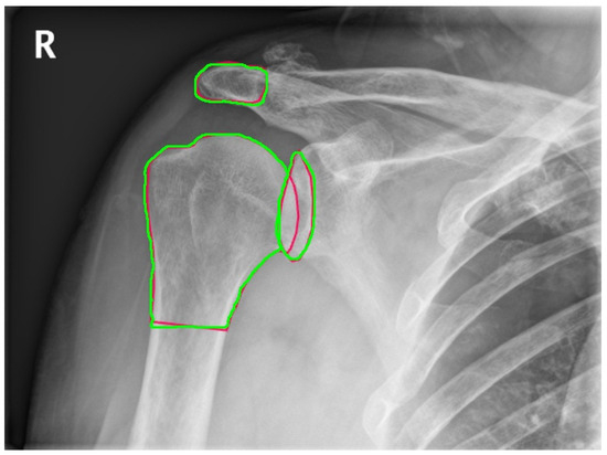 The Development of a Yolov8-Based Model for the Measurement of Critical ...