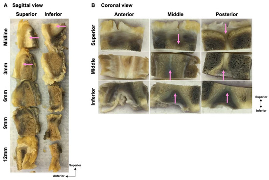 Cleft Sign in MRI May Represent the Disruption of Cartilage Structure ...