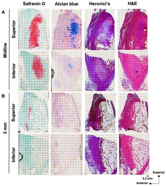 Cleft Sign in MRI May Represent the Disruption of Cartilage Structure ...