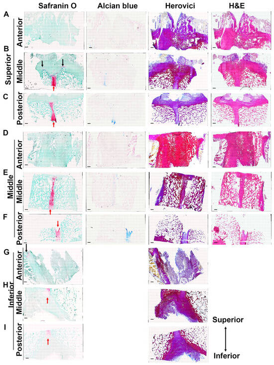 Cleft Sign in MRI May Represent the Disruption of Cartilage Structure ...