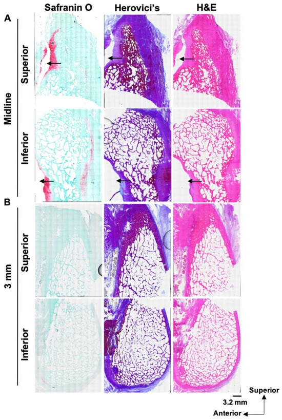 Cleft Sign in MRI May Represent the Disruption of Cartilage Structure ...