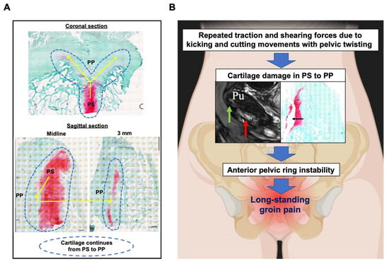 Cleft Sign in MRI May Represent the Disruption of Cartilage Structure ...
