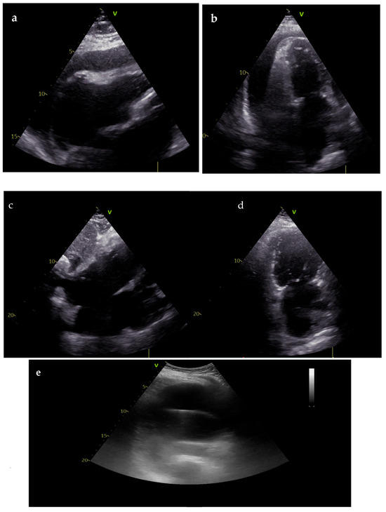 Echocardiography in Cardiac Arrest: Incremental Diagnostic and ...