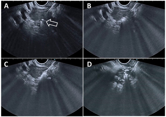 EUS-Guided Radiofrequency Ablation Therapy for Pancreatic Neoplasia