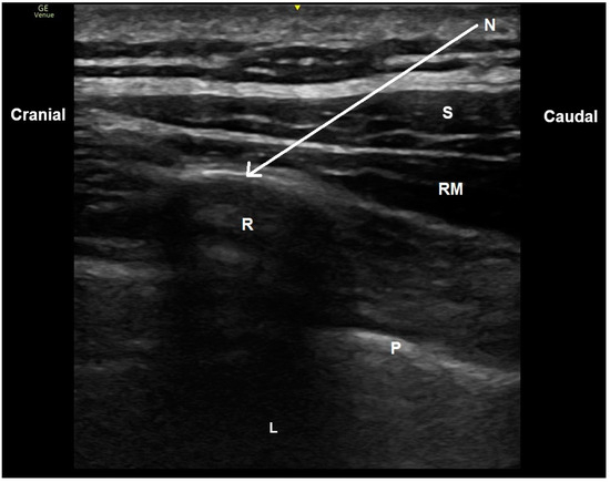 Can Rhomboid Intercostal Block Be an Alternative to Paravertebral Block ...