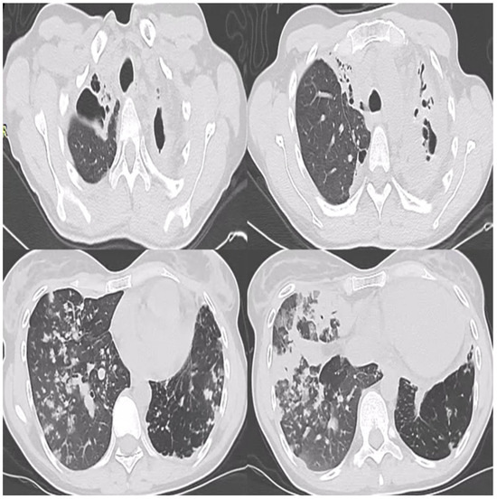 Novel Treatment for Pre-XDR Tuberculosis Linked to a Lethal Case of ...