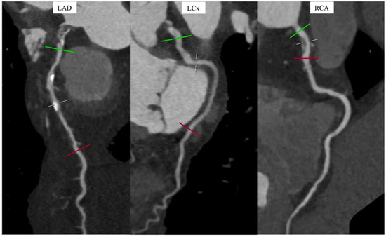 Kugel’s Artery in Coronary Computed Tomography Angiography in a Patient ...