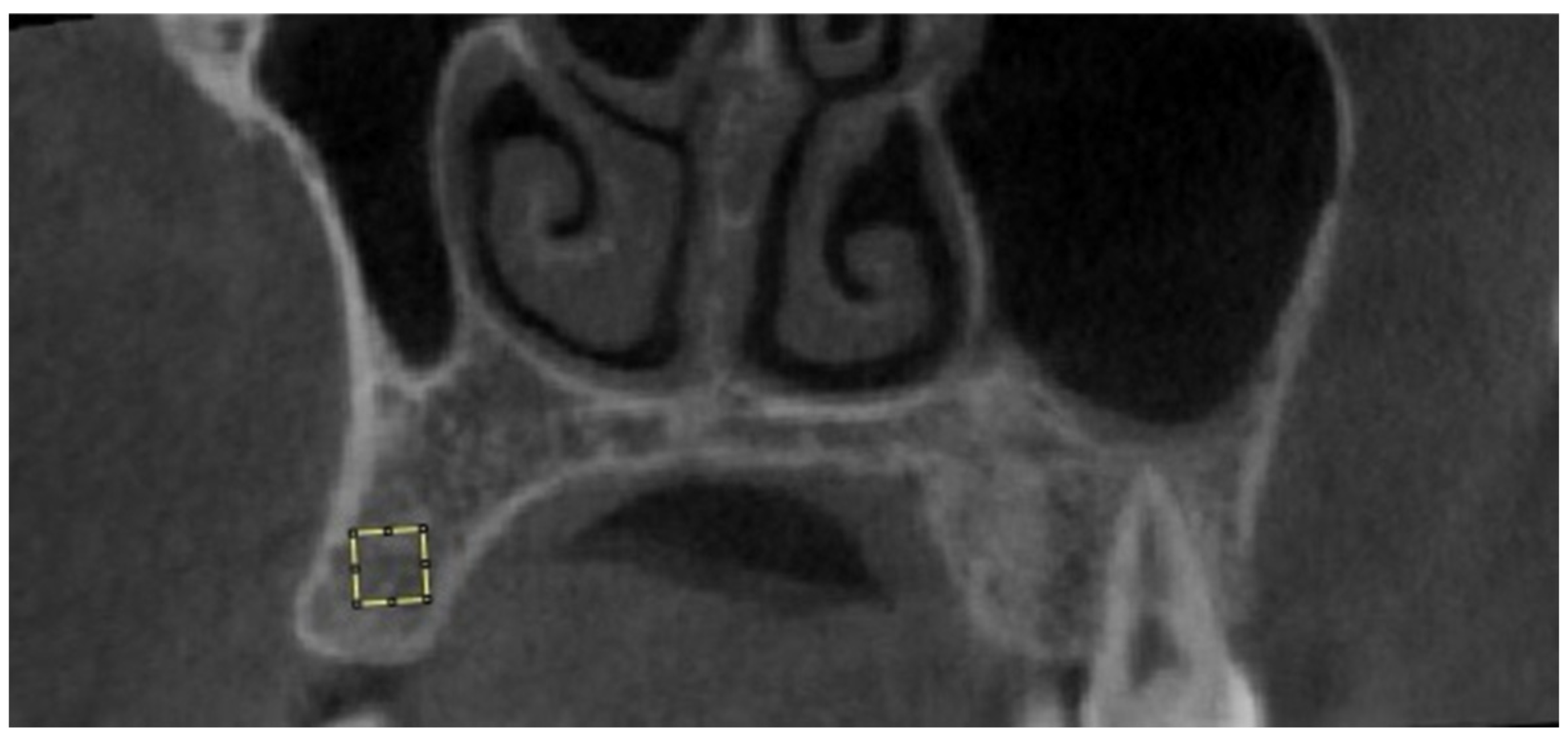 Assessment of the Trabecular Bone Microstructure Surrounding Impacted ...