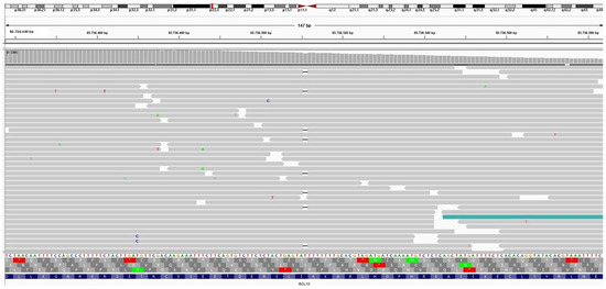 Different Shades of Desmoid-Type Fibromatosis (DTF): Detection of Noval ...