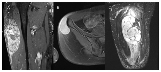 Predicting the Malignancy Grade of Soft Tissue Sarcomas on MRI Using ...