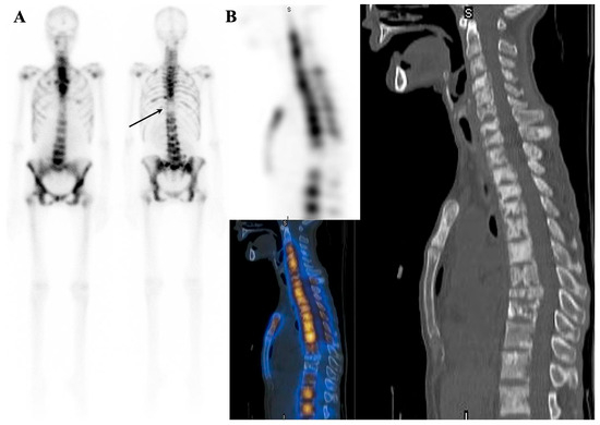 Superscan Pattern on Bone Scintigraphy: A Comprehensive Review