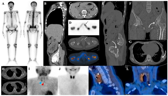 Superscan Pattern on Bone Scintigraphy: A Comprehensive Review