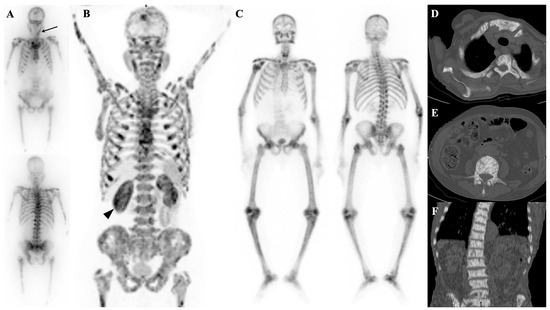 Superscan Pattern on Bone Scintigraphy: A Comprehensive Review